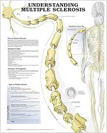 Understanding Multiple Sclerosis Anatomical Chart: 9781587799716 ...