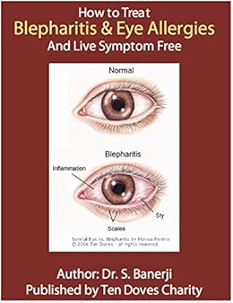 How to treat Blepharitis and Eye Allergies and live symptom free ...