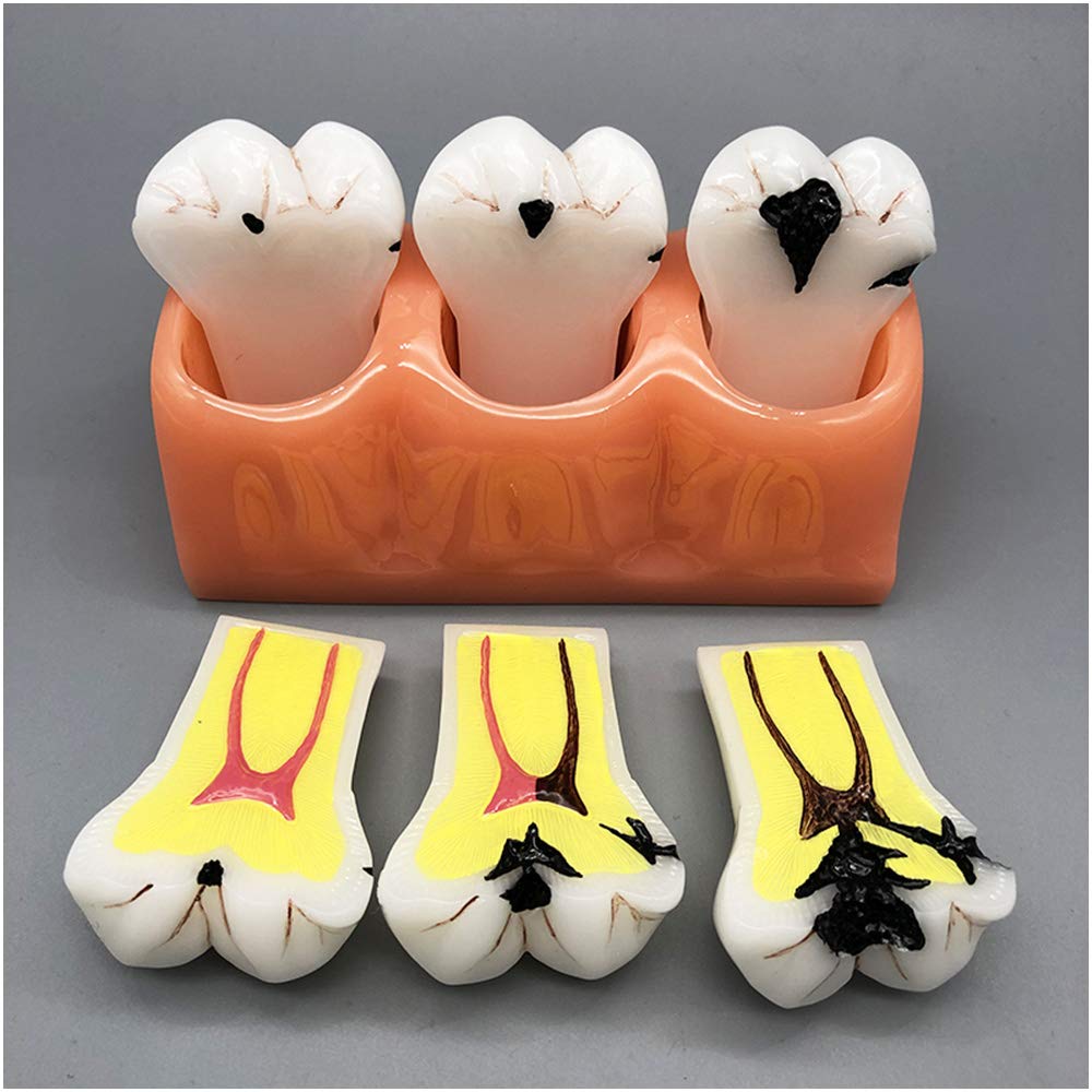 Buy FHUILI 4X Large Teeth Model - Tooth Decay Pathological Caries Model ...