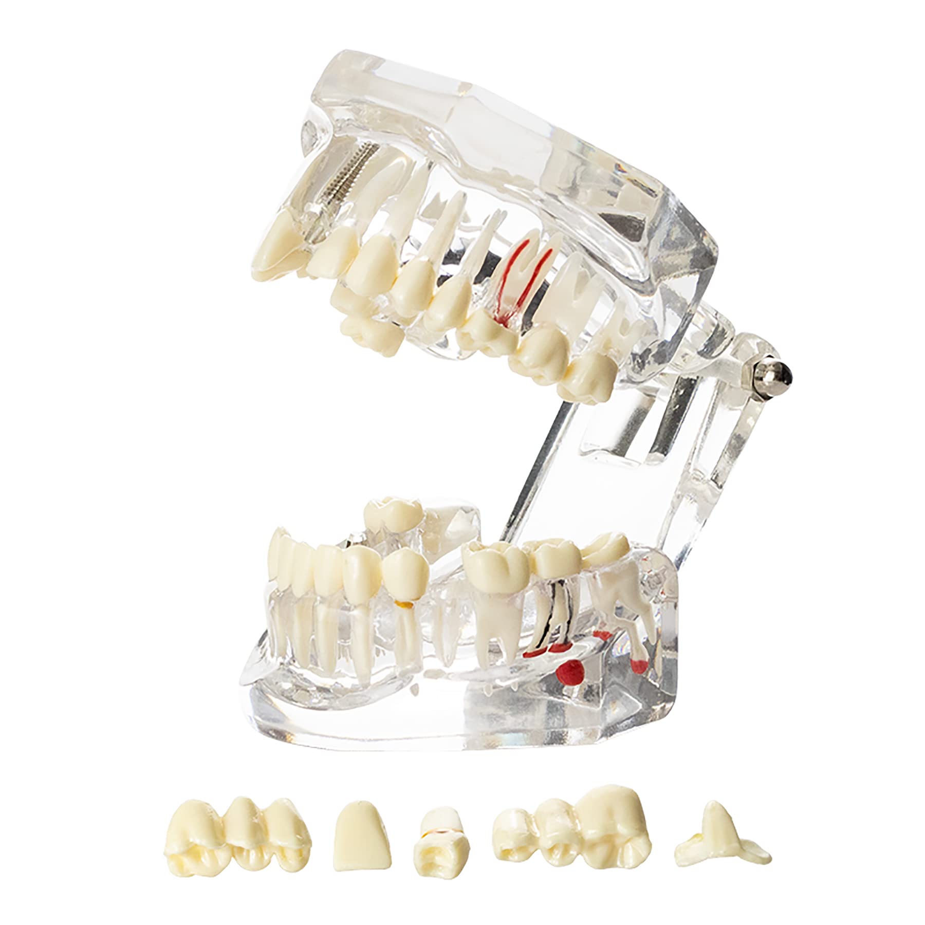 Dentalmall Dental Oral Typodont Model Implant Pathological Removable ...