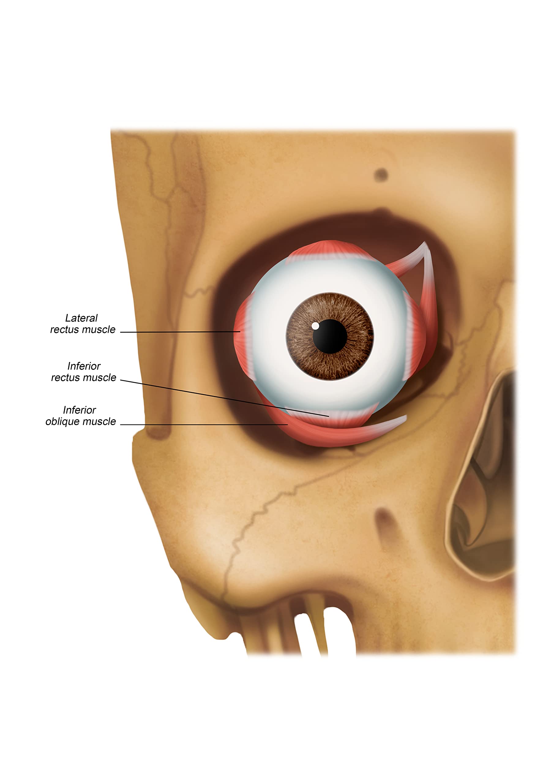 Mua Remote Anchorage Solutions for Severe Maxillary Atrophy: Zygomatic ...