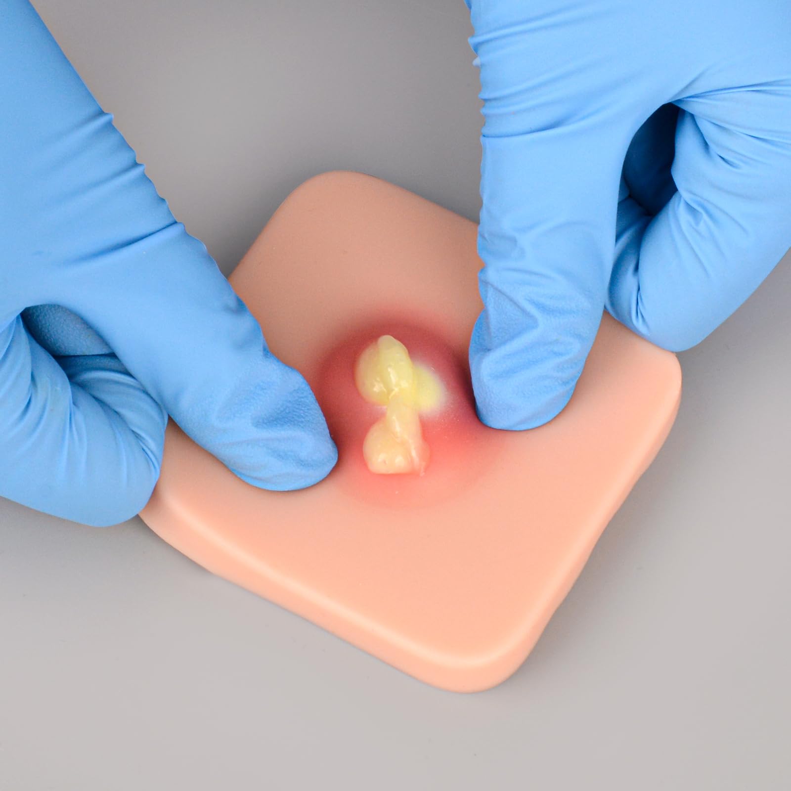 Suture Skin Ultrassist Abscess I&D Incision And Drainage Pad Burundi ...