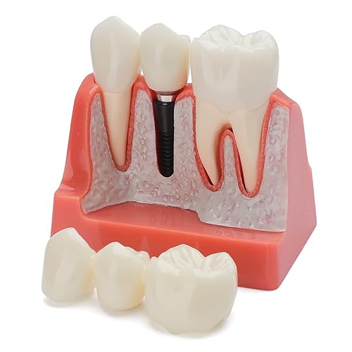 Healthible Dental Implant Model - Implant Vs Bridge Dental Model 4 ...