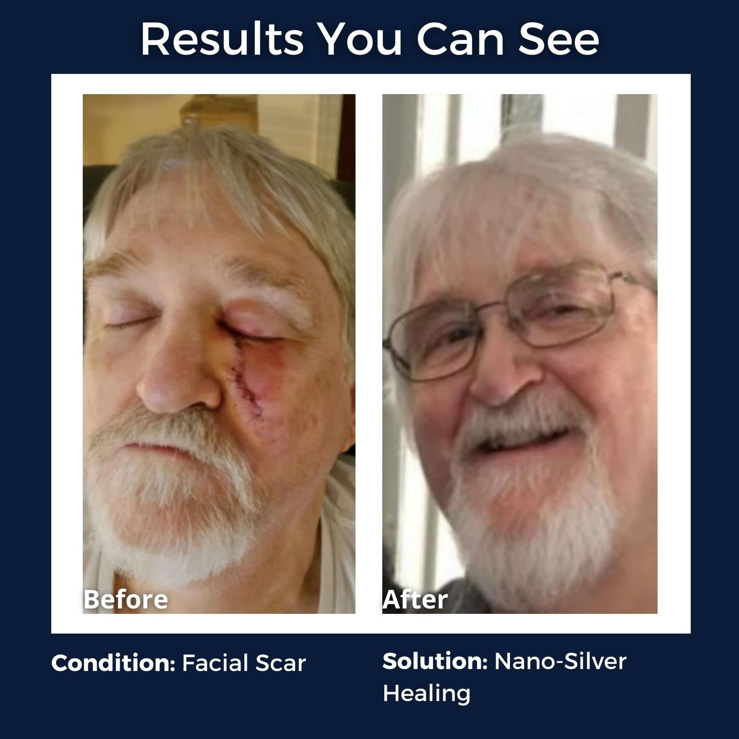 Mua OPTIVIDA Colloidal Silver Gel For Wound Care, Natural Topical Skin ...