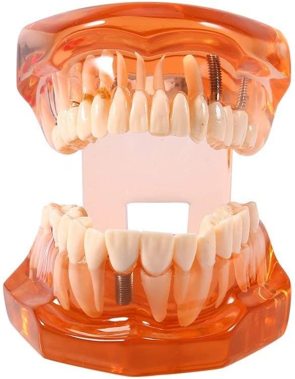 Dental Teeth Removable Tooth Model Tooth Prosthesis Demonstration Teeth ...