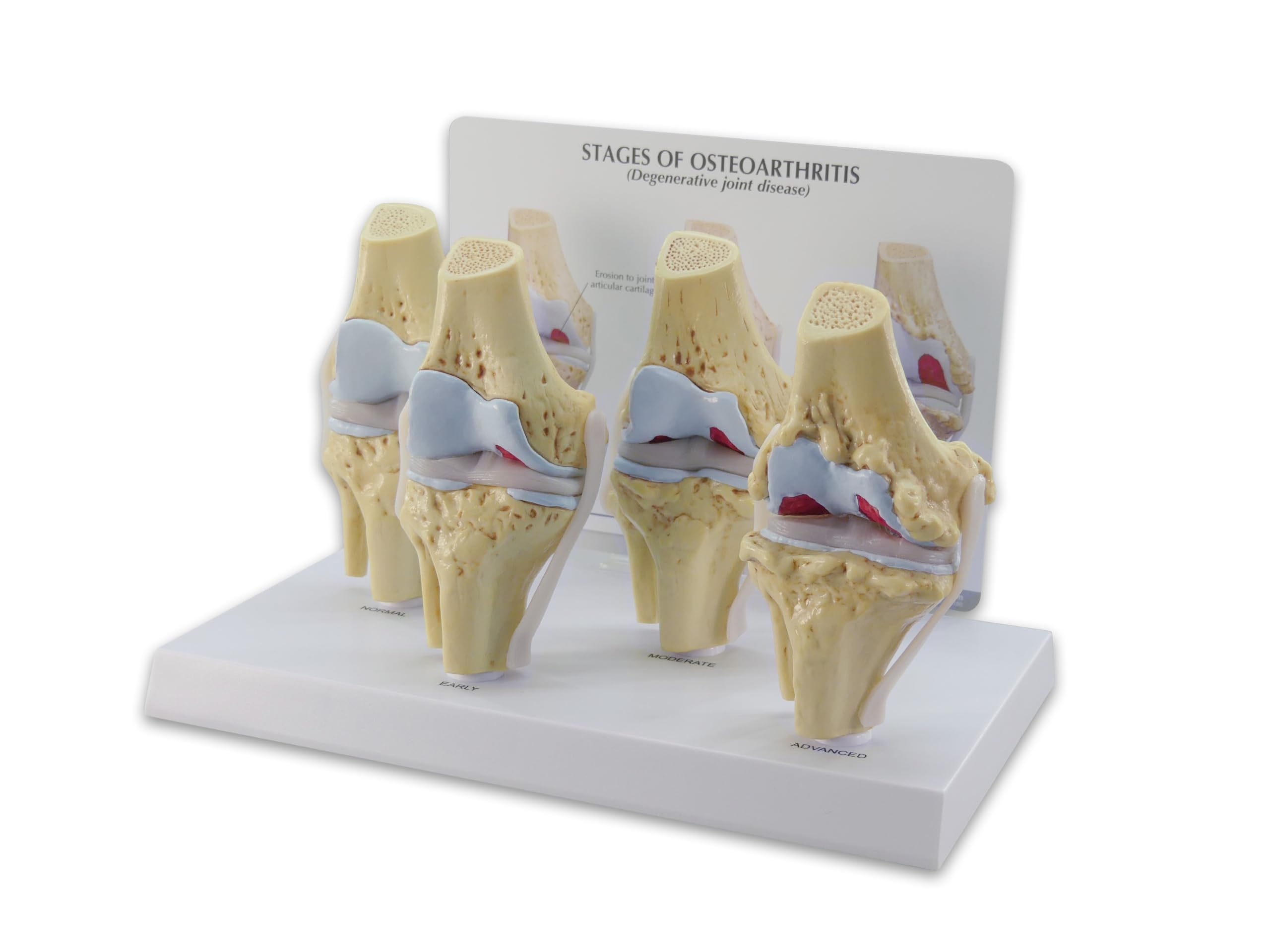 Mua Knee Set 3/4 size Osteoarthritis Set of 4 Anatomical Model w ...