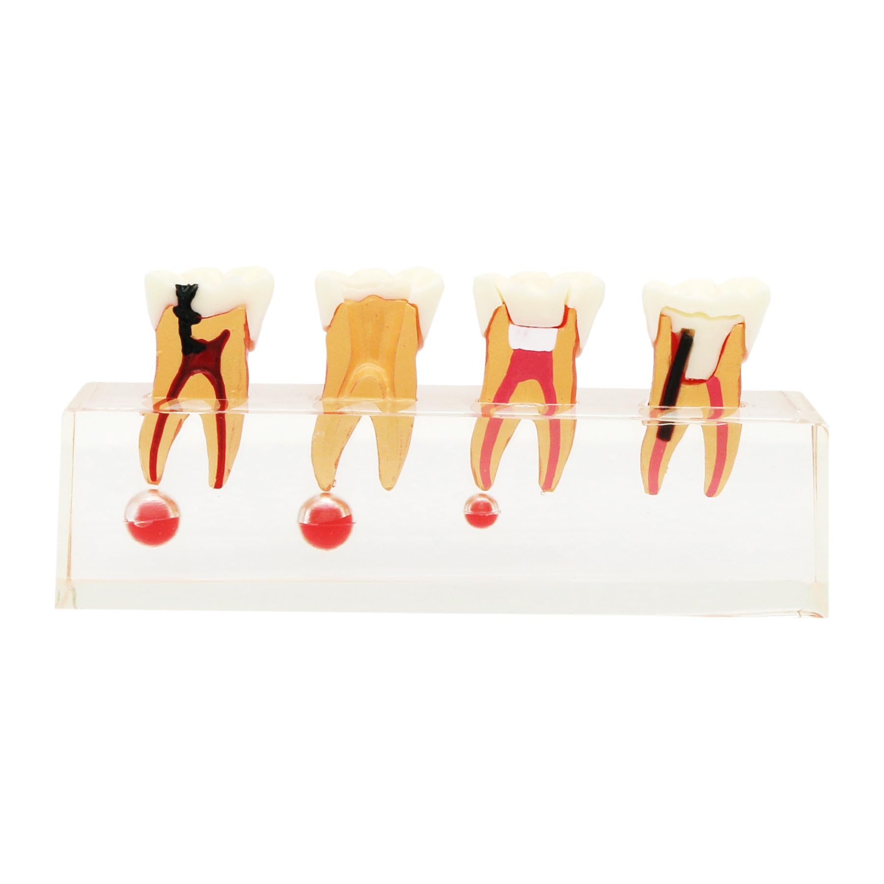 Mua Dental 4-Stage Endodontic Treatment Model for Study Teach Teeth ...
