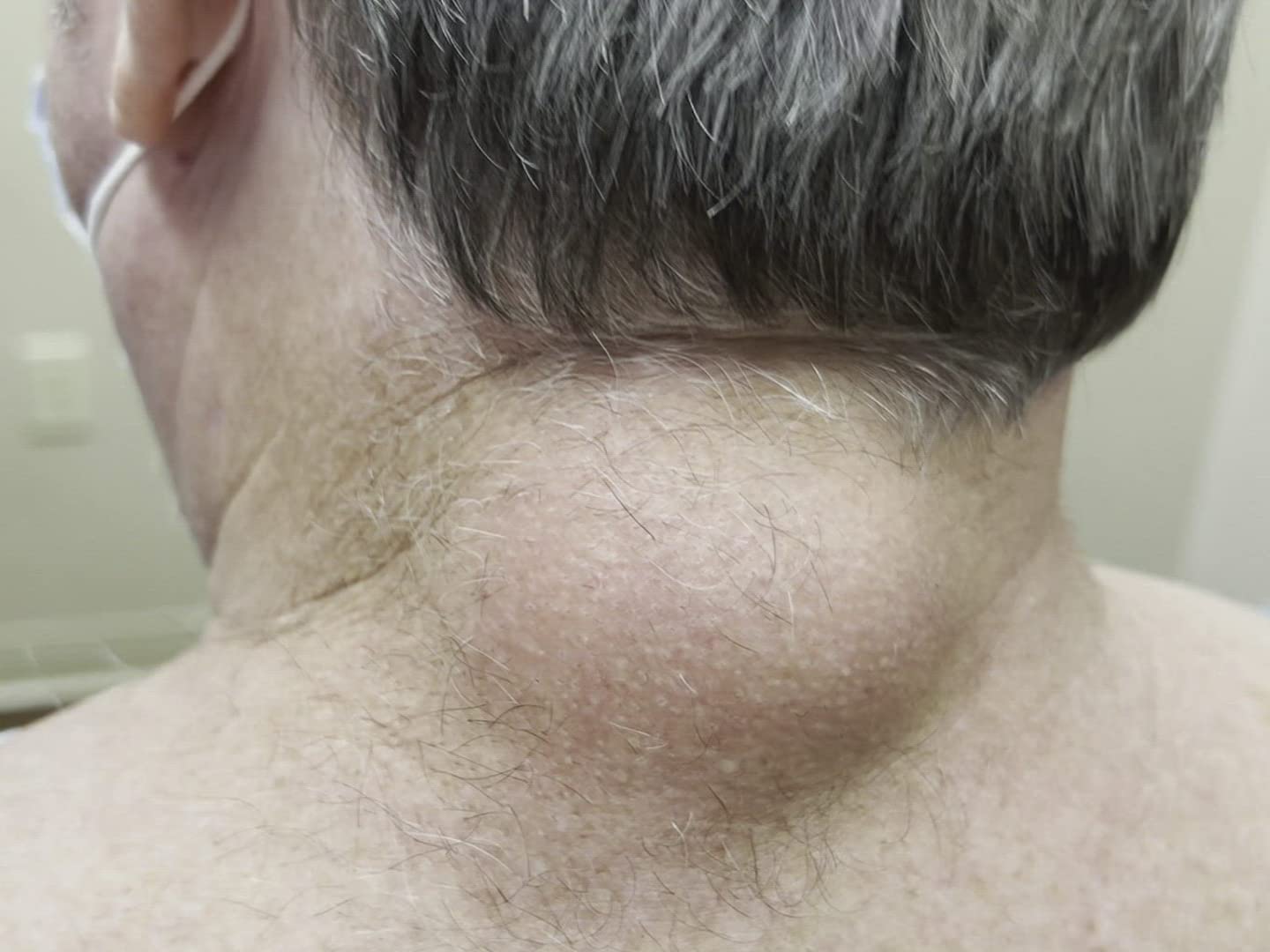 Watch Dr. Pimple Popper: This Is Zit - Season 10 | Prime Video