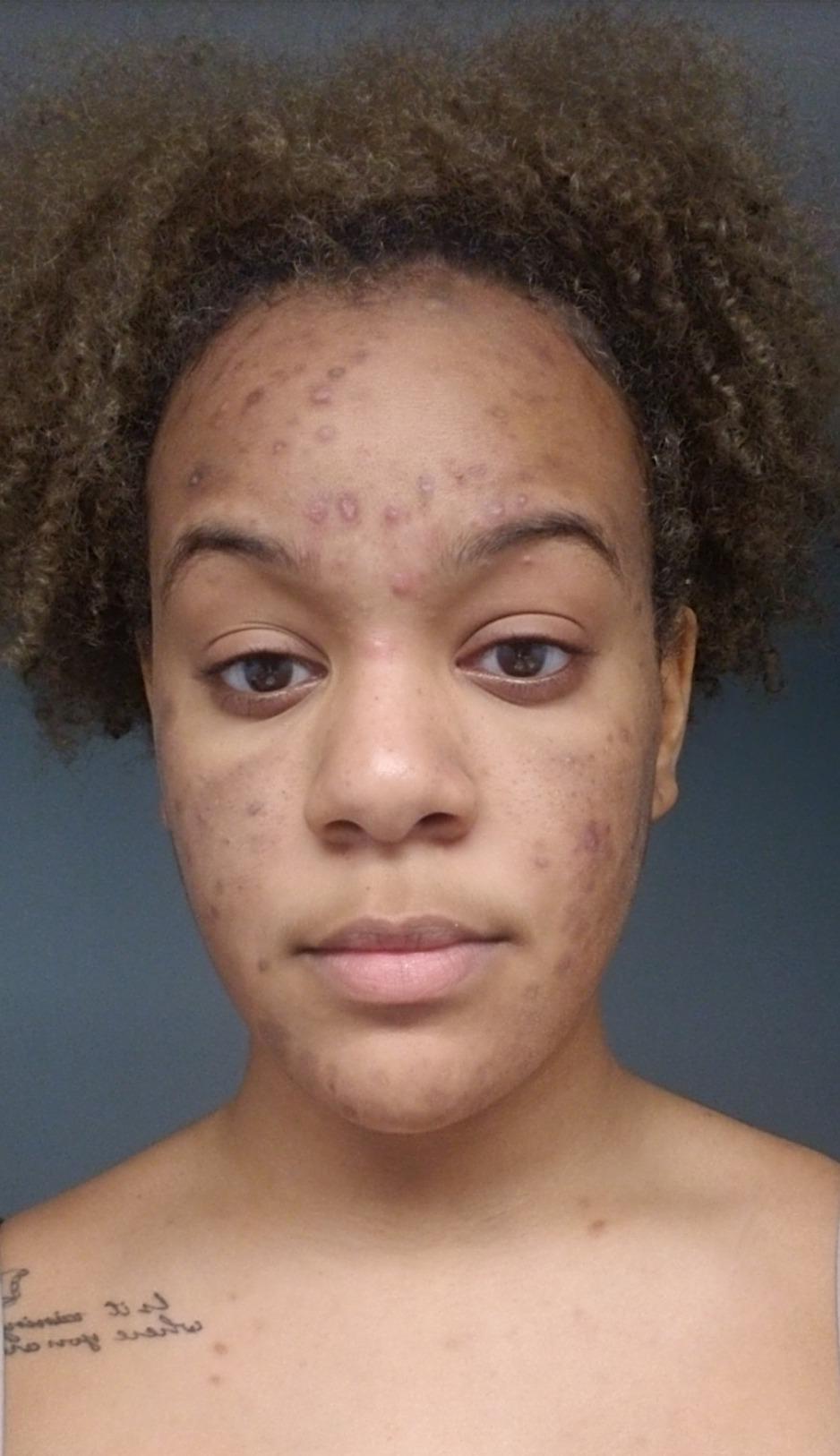 Great for New Scars!