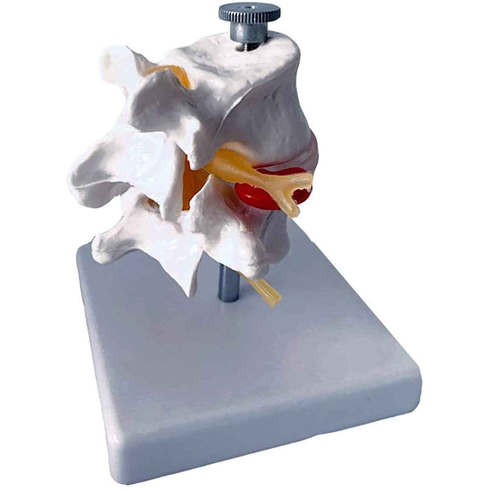 Mua Anatomical Model Spine Lumbar Disc Herniation Model Anatomical ...