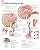 Understanding Stroke chart: Wall Chart in Kuwait | Whizz Cardiology