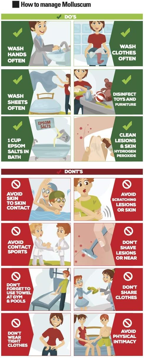 Conzerol. Molluscum Contagiosum Solution, Cream, 22ml – BigaMart