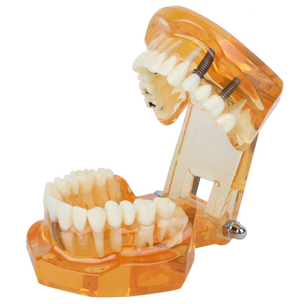 Dental Tooth Model Disease Tooth Model Implant Teeth Removable Tooth ...