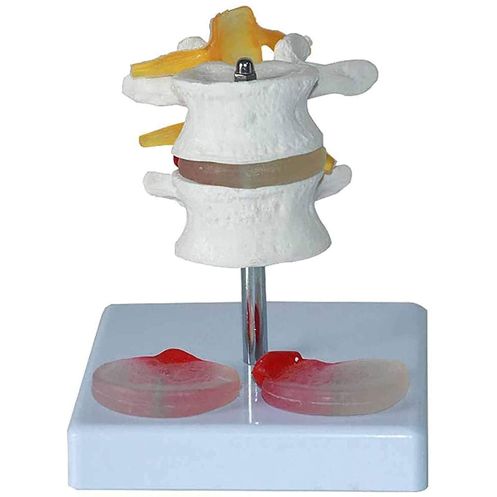 Mua Human Spine Lumbar Vertebrae Model Lumbar Disc Herniation ...
