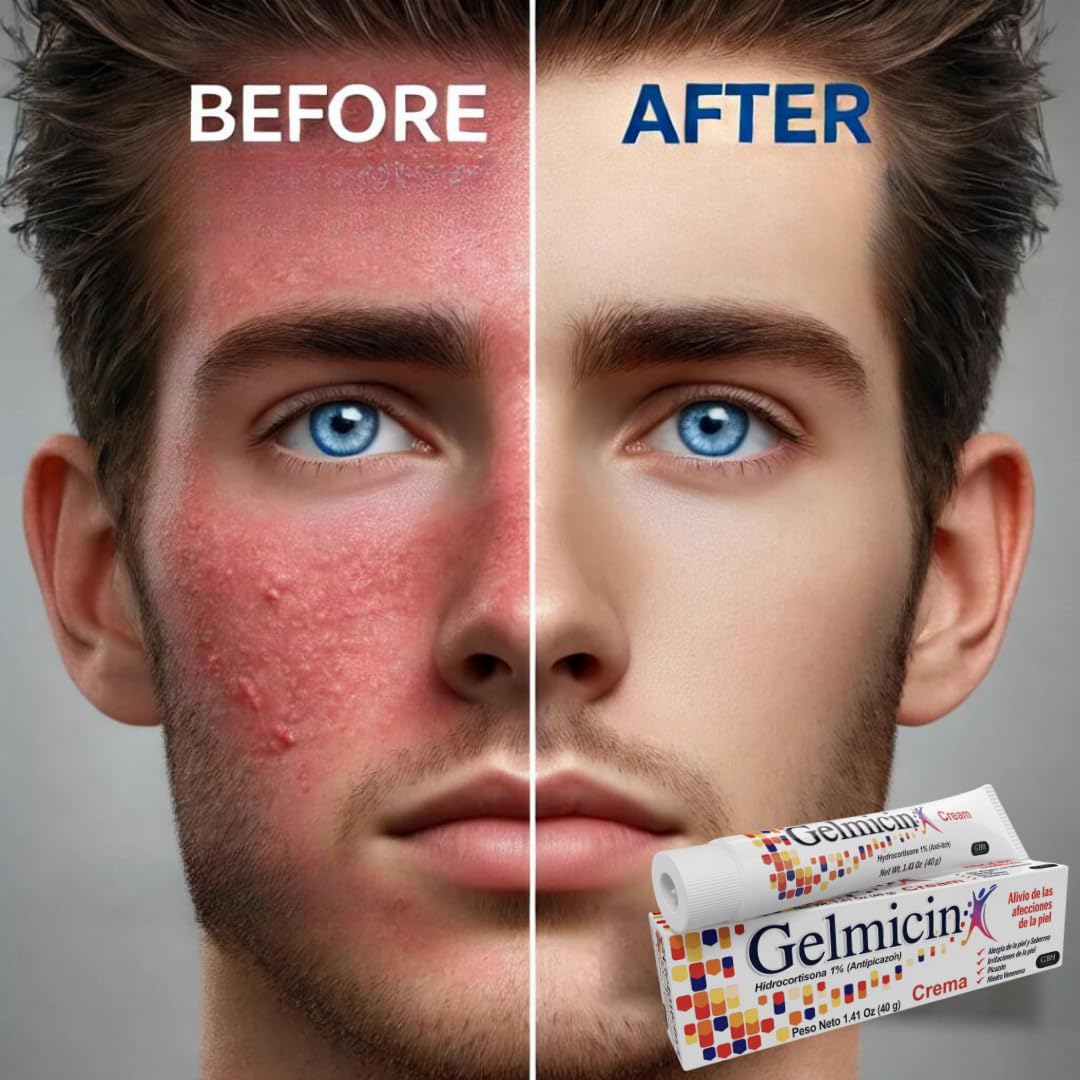 Mua Gelmicin Hydrocortisone 1% - Anti-Itch Cream, Skin Rash, Skin ...