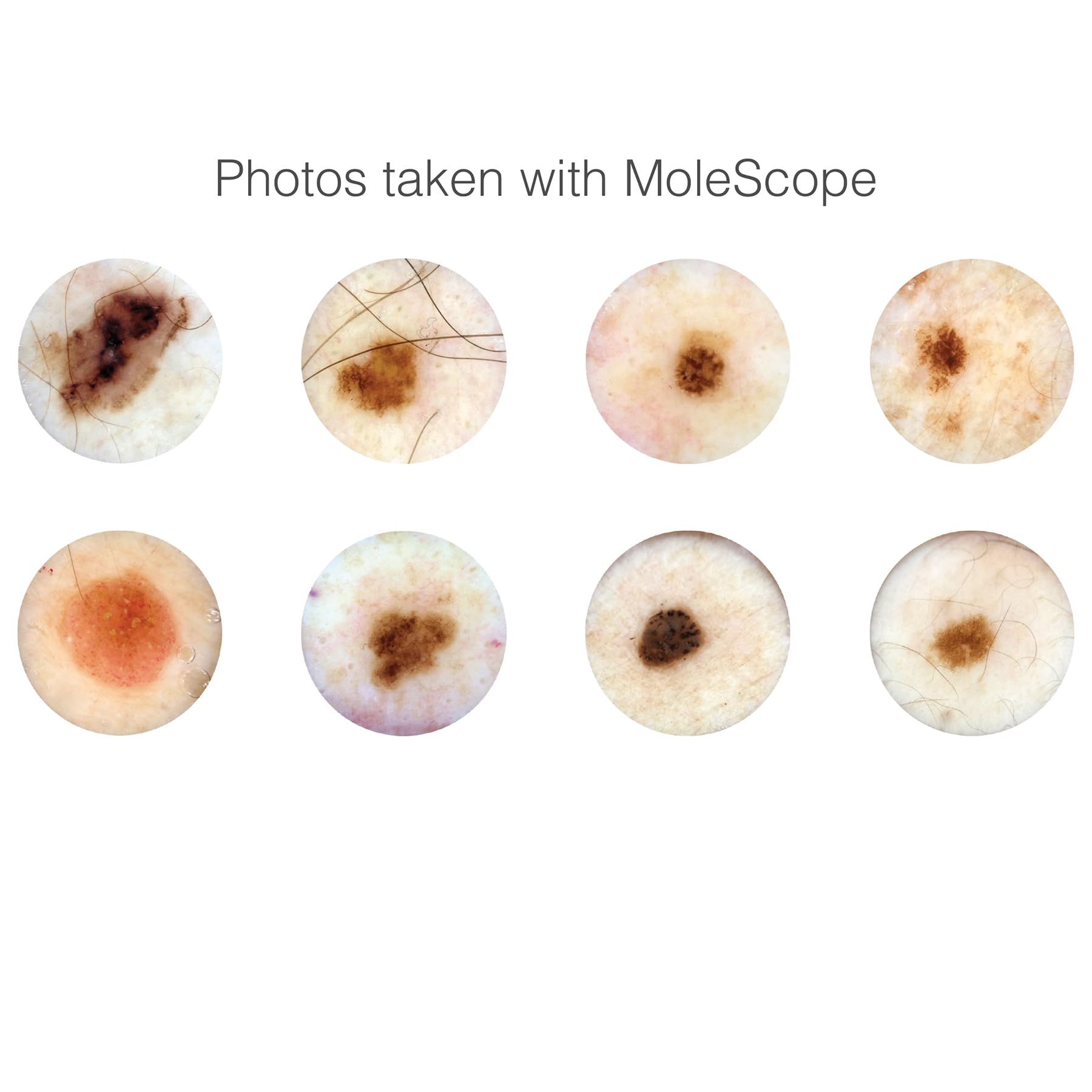Mua MoleScope Dermatoscope Skin Cancer Digital Microscope | Mole ...
