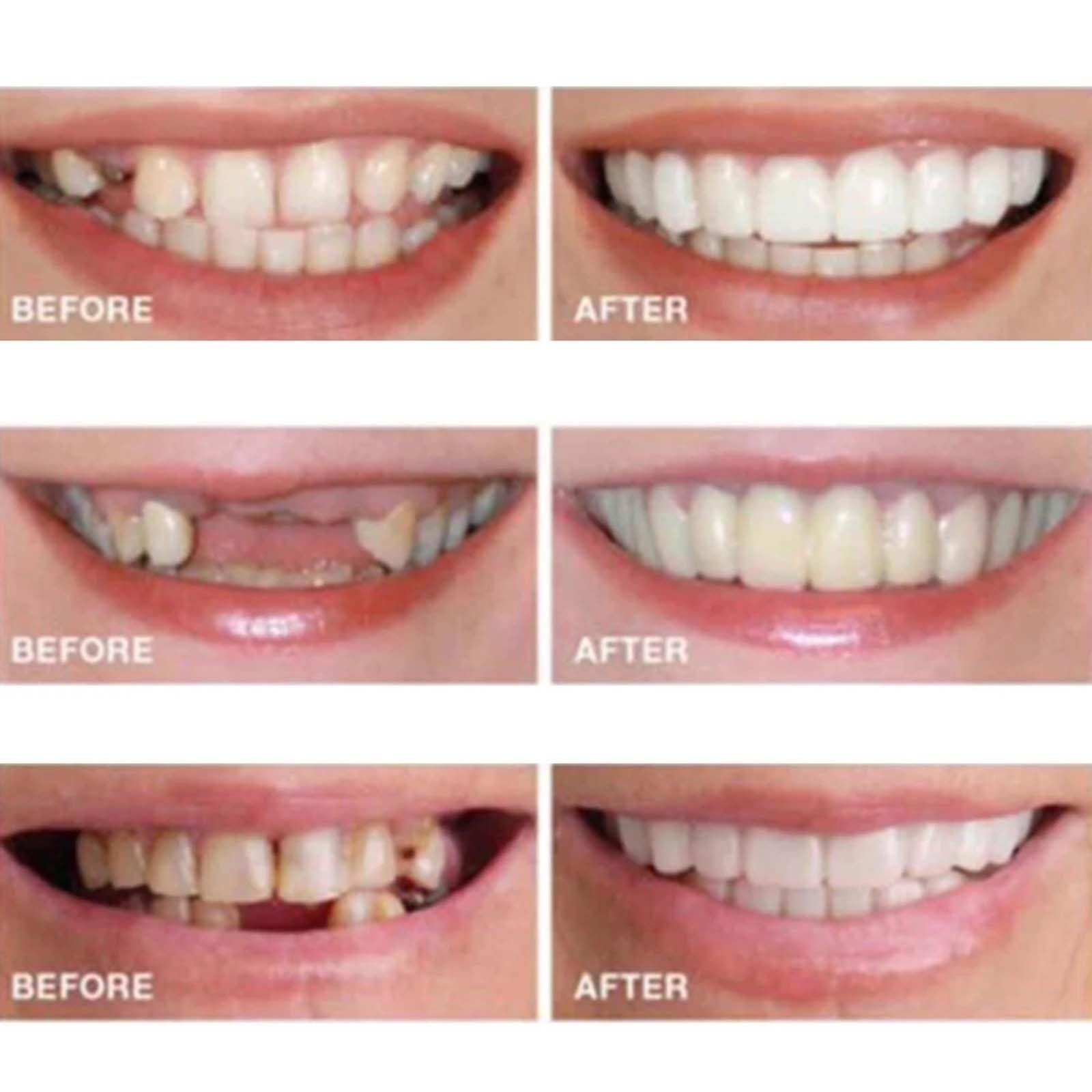 Mua Dentures, 2 male and female dentures, upper and lower jaw temporary ...