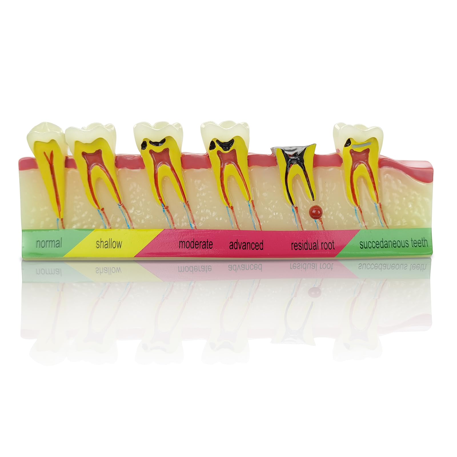 MediTrainer Teeth Model,Dental Periodontal Disease Model, Dental ...