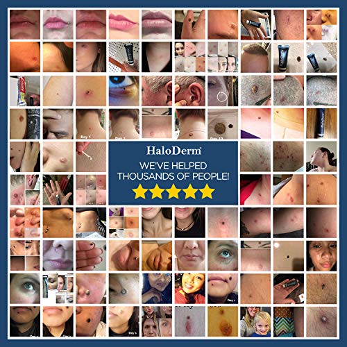 [쇼핑365 아마존직구 추천상품] HaloDerm Skin Tag Remover & Mole Remover - All ...