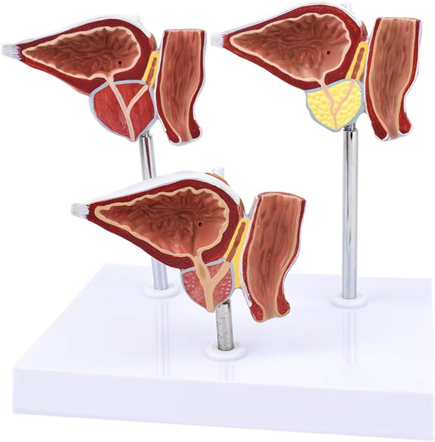 Taille de la vie de la prostate modèle - et normal Lésion Présentation ...