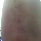 Dermfix 1000MX UV-B Lamp for Psoriasis, Vitiligo or Eczema: Amazon.ca ...