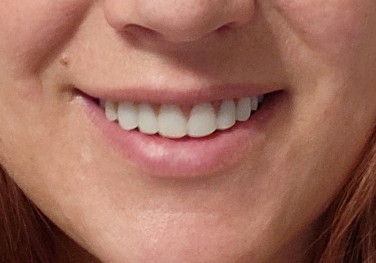 $9/mo - Finance Instant Smile Complete Adult Makeover Kit! Fix Your ...