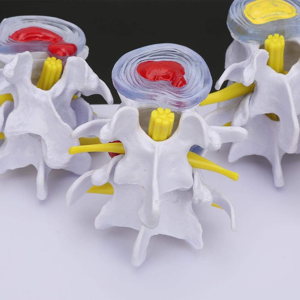 Hililand 4 Steps Anatomical Vertebrae Model Combination of Human Lumbar ...
