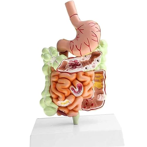 Intestine Human Gastrointestinal Model,Large Intestine Pathology Model ...