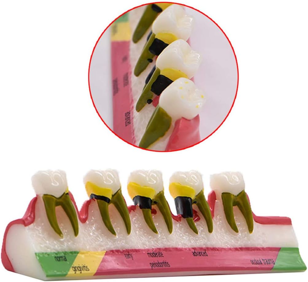 Dental Teeth Model, Periodontal Disease Assort Tooth Typodont Teach ...