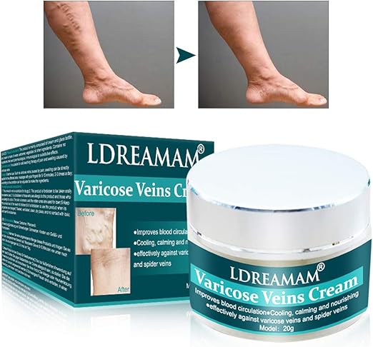 Crema para Varices, Ungüento De Tratamiento De Alivio De Varices, Ayuda ...