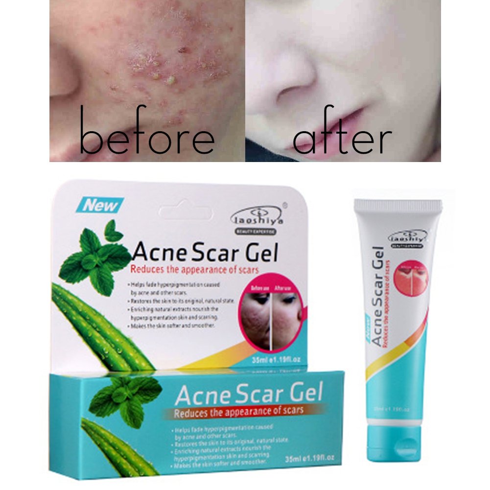 Acne Scar Gel, Acne Scar Treatment, Acne Pimple Spot Scar Removal Gel ...