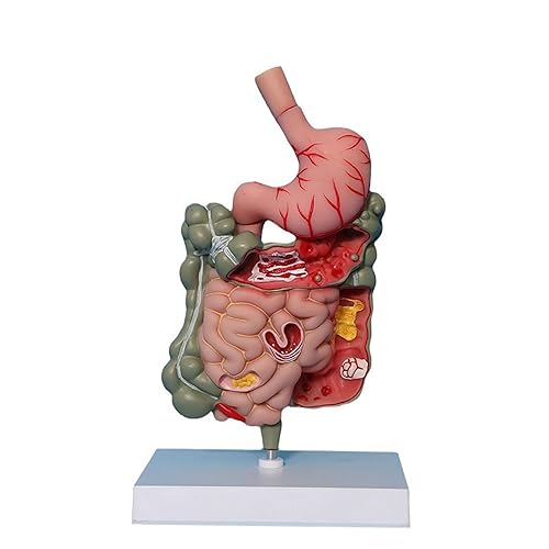 Human Stomach Anatomy Model Pathological Digestive System Model ...