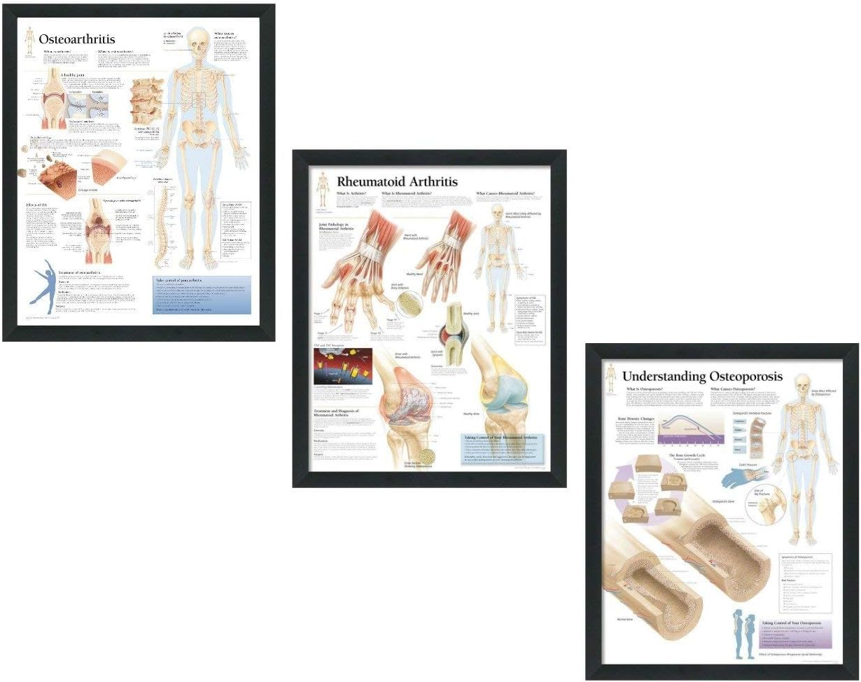 Set of 3 Framed Medical Posters Osteoarthritis Rheumatoid Arthritis ...