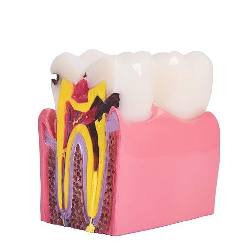 ANNWAH Dental Caries Teeth Model,Dental Anatomy Education Tooth Model,6 ...