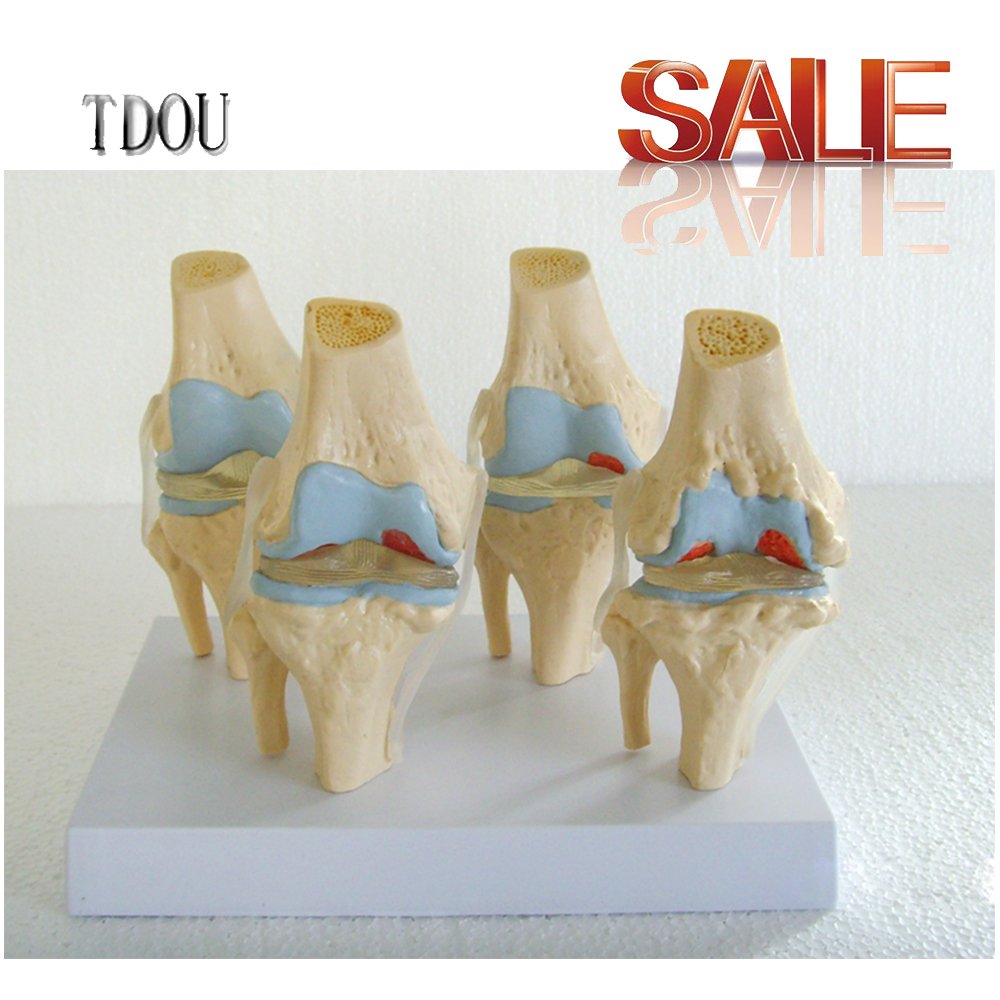 Human Knee Degenerative Lesions 4 Stage Normal And Morbid State ...