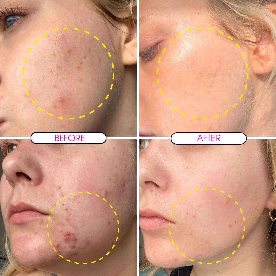 Mua Clear Skin Days 2% Niacinamide, 2% Salicylic Acid, & 1% Zinc Spot ...