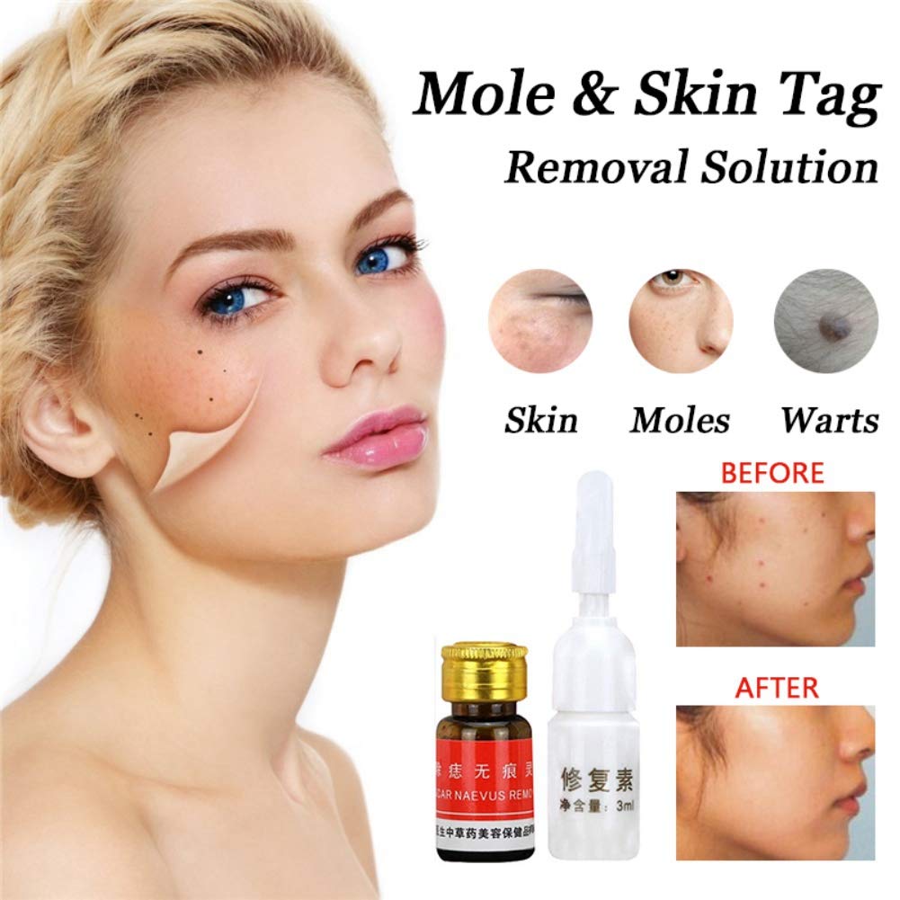 Buy Mole Skin Tag Removal Solution Painless Mole Skin Dark Spot Removal Buy Mole Skin Tag Removal Solution Painless Mole Skin Dark Spot Removal