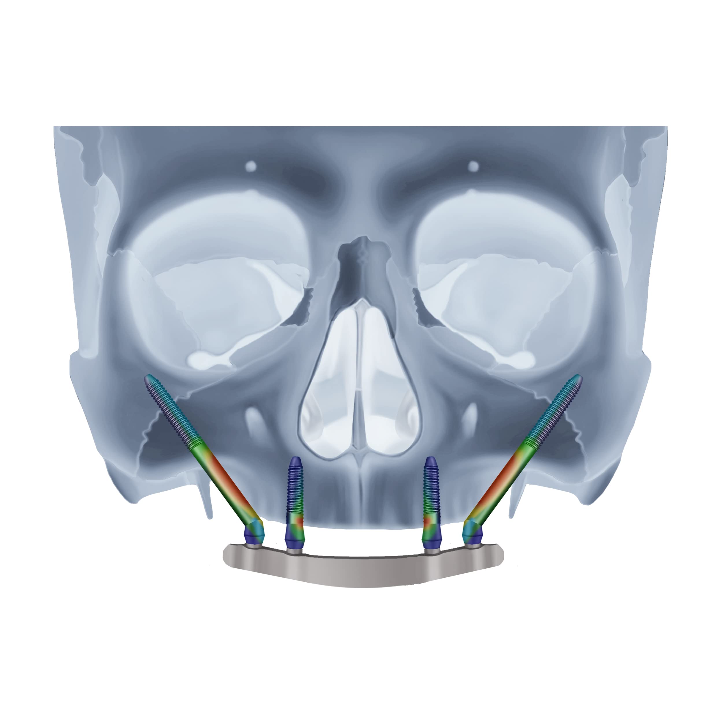 Mua Remote Anchorage Solutions for Severe Maxillary Atrophy: Zygomatic ...