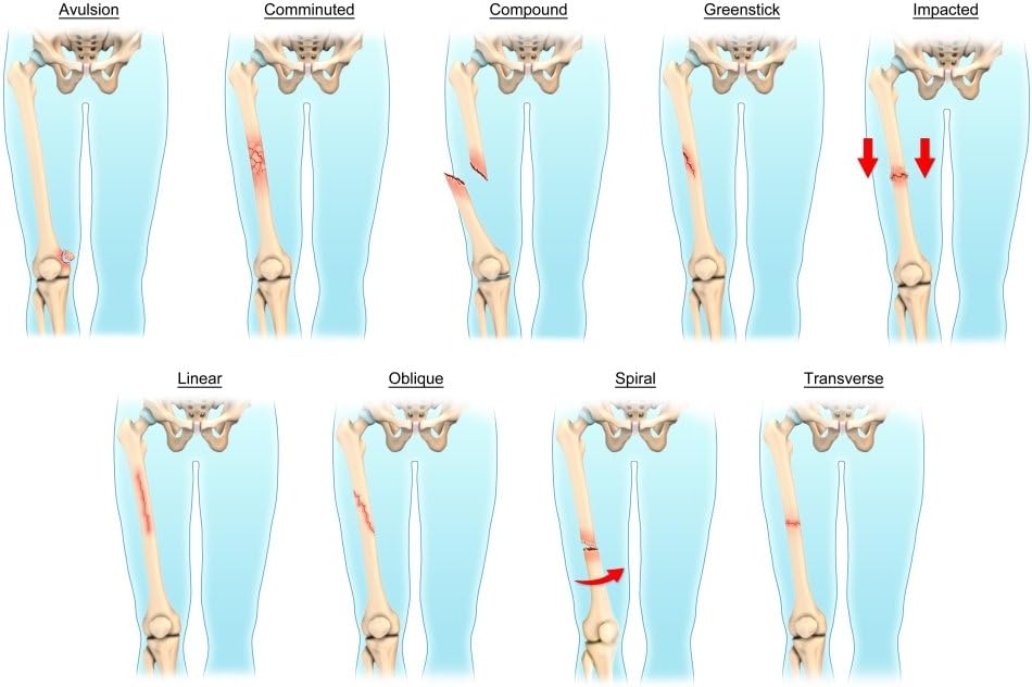 4 Types Of Bone Fractures 4 Types Of Bone Fractures