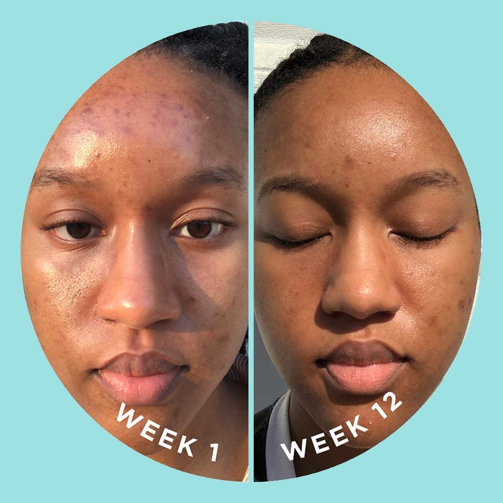 Mua Blur Potion? by ZitSticka, Vitamin Supplement to Fade The ...