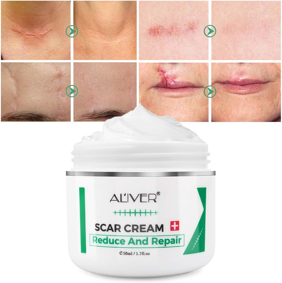 Scar Removal Cream – Effective Stretch Mark Removal – Natural Skin ...
