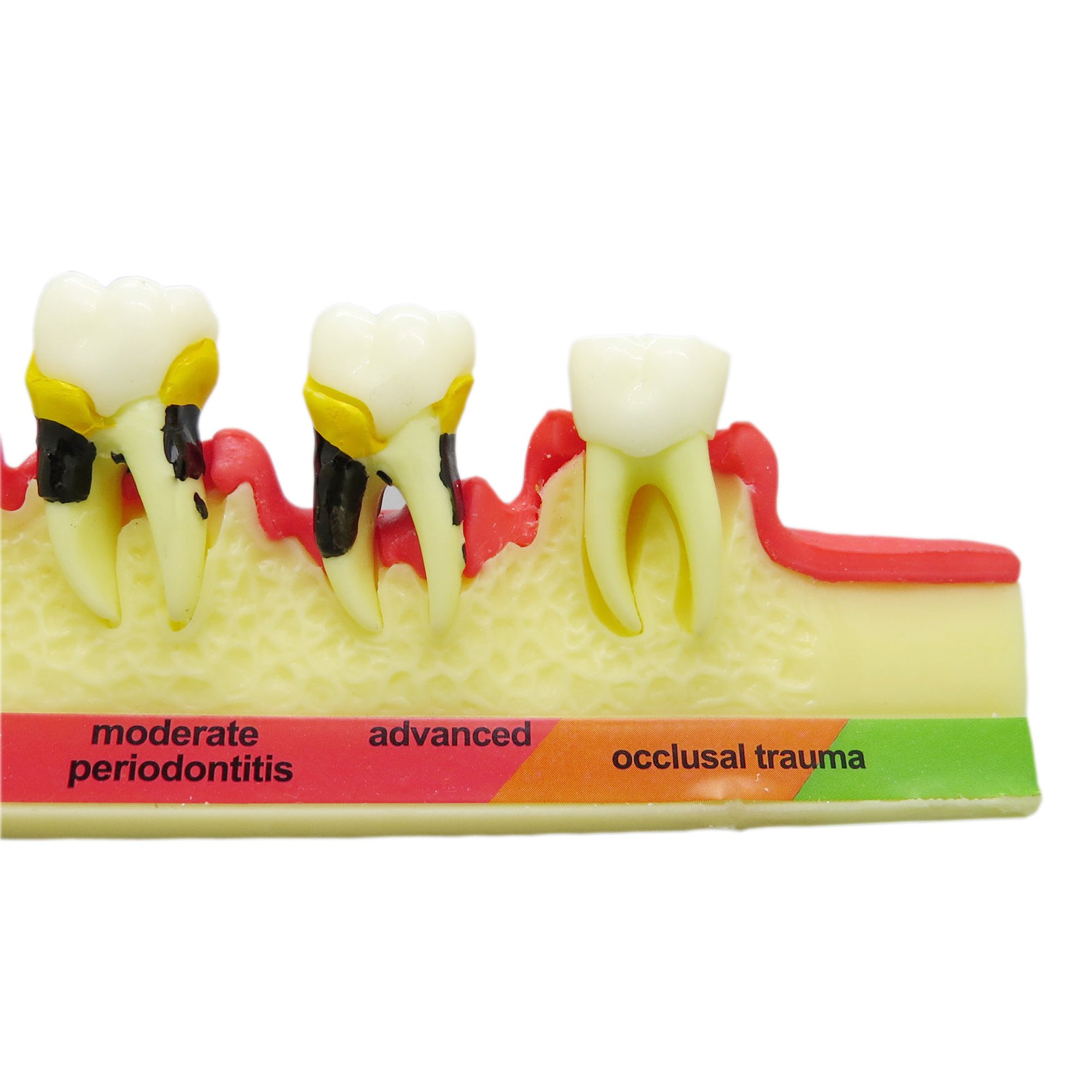 Mua Teeth Periodontal Disease Model Dental Caries Breakdown Display ...