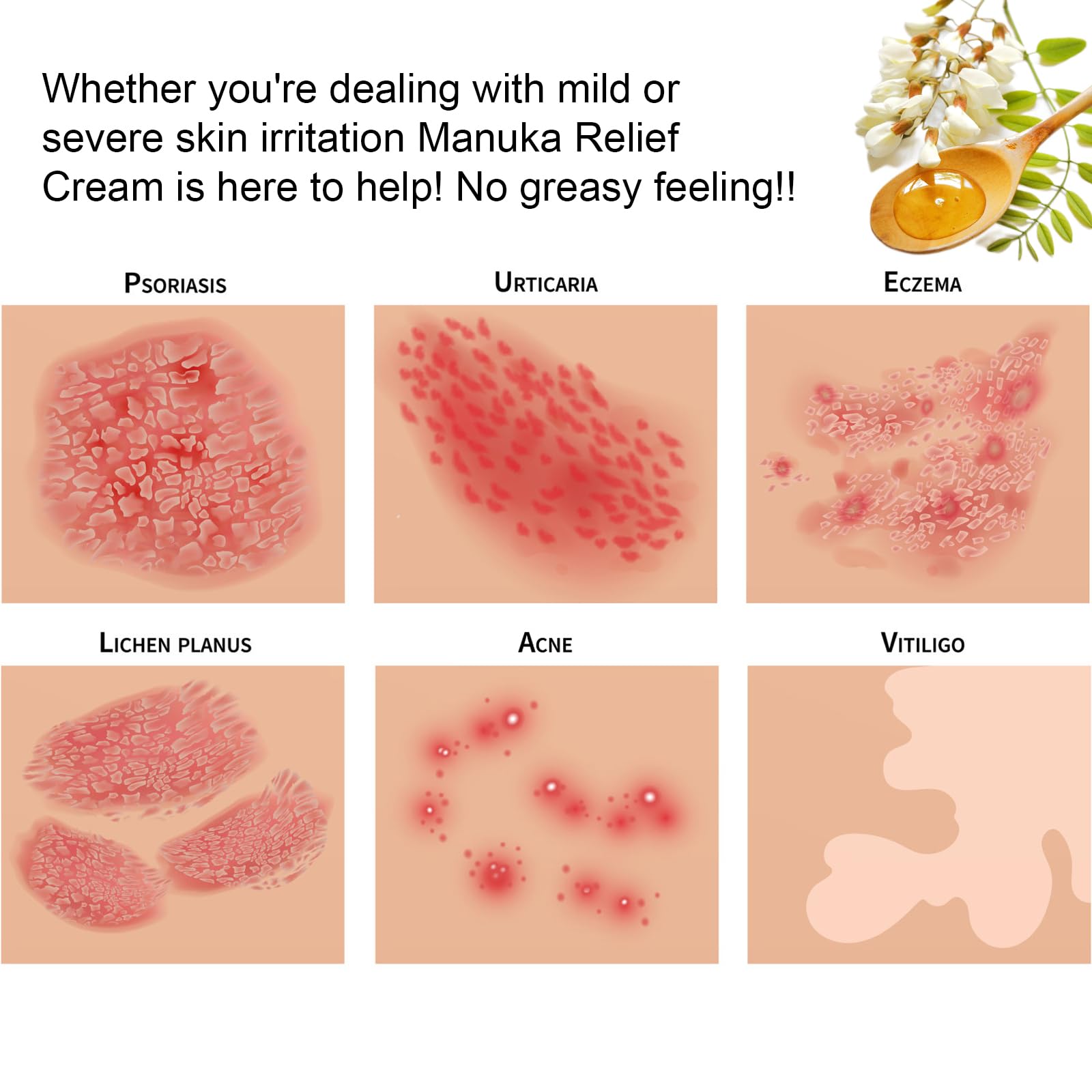 Mua 1 Pack Manuka Honey Eczema, Tea Tree Oil, Heat Rash Cream, Jock ...