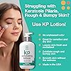 TOUCH Glycolic Acid Lotion for Keratosis Pilaris - KP Exfoliating Body ...