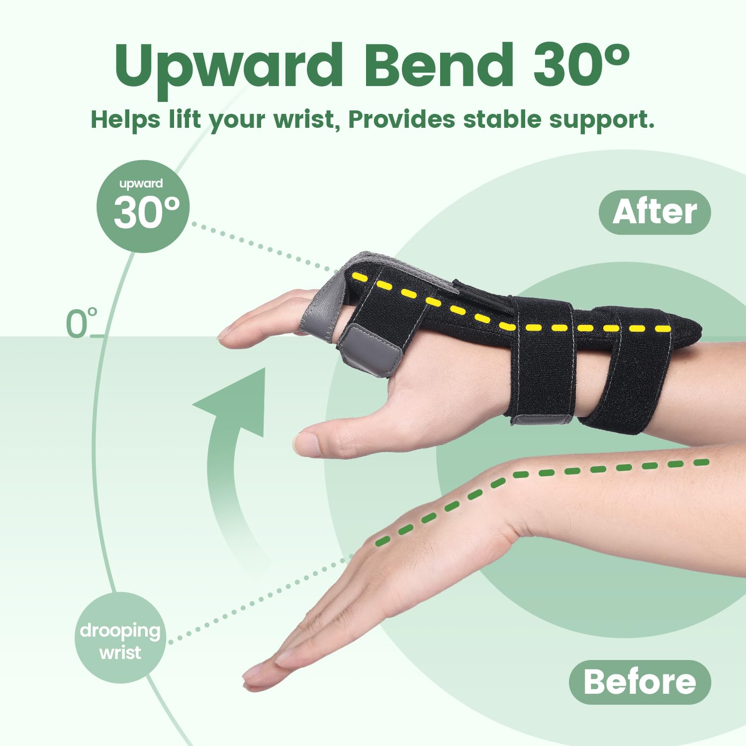 Mua Radial Nerve Palsy Brace Splint for Finger Extension, Wrist Drop, Crutch Palsy, Mcp ...