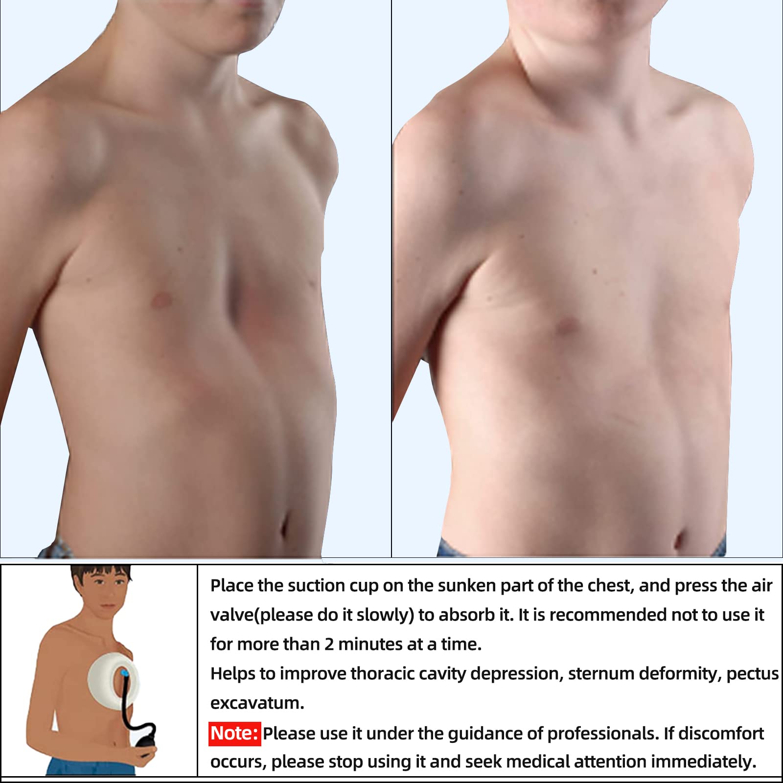 Tairibousy Pectus Excavatum Orthosis Brace, Sternal Depression Support ...