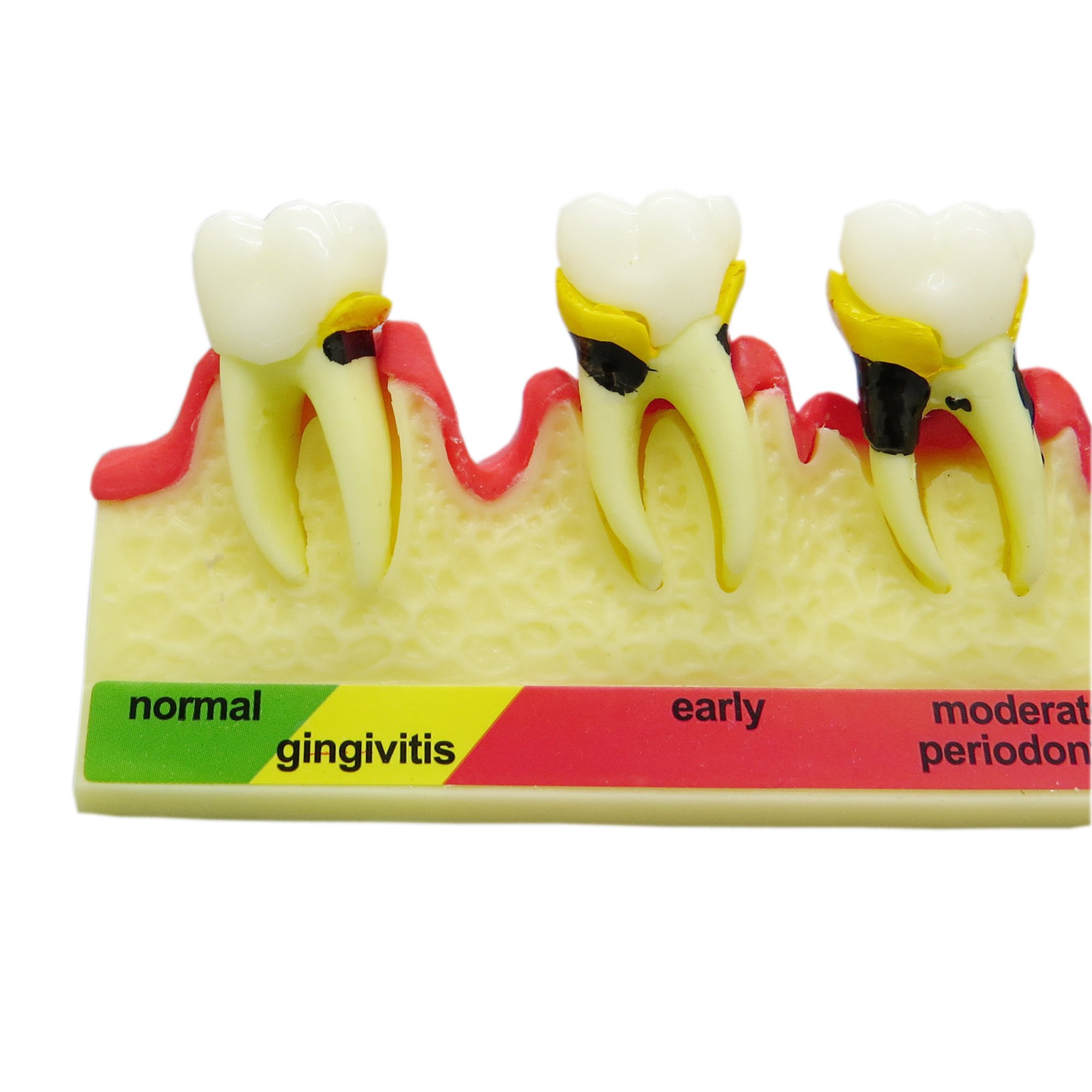 Mua Teeth Periodontal Disease Model Dental Caries Breakdown Display ...