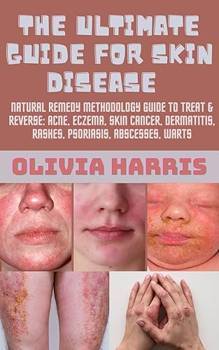 The Ultimate Guide For Skin Disease : Natural Remedy Methodology Guide ...