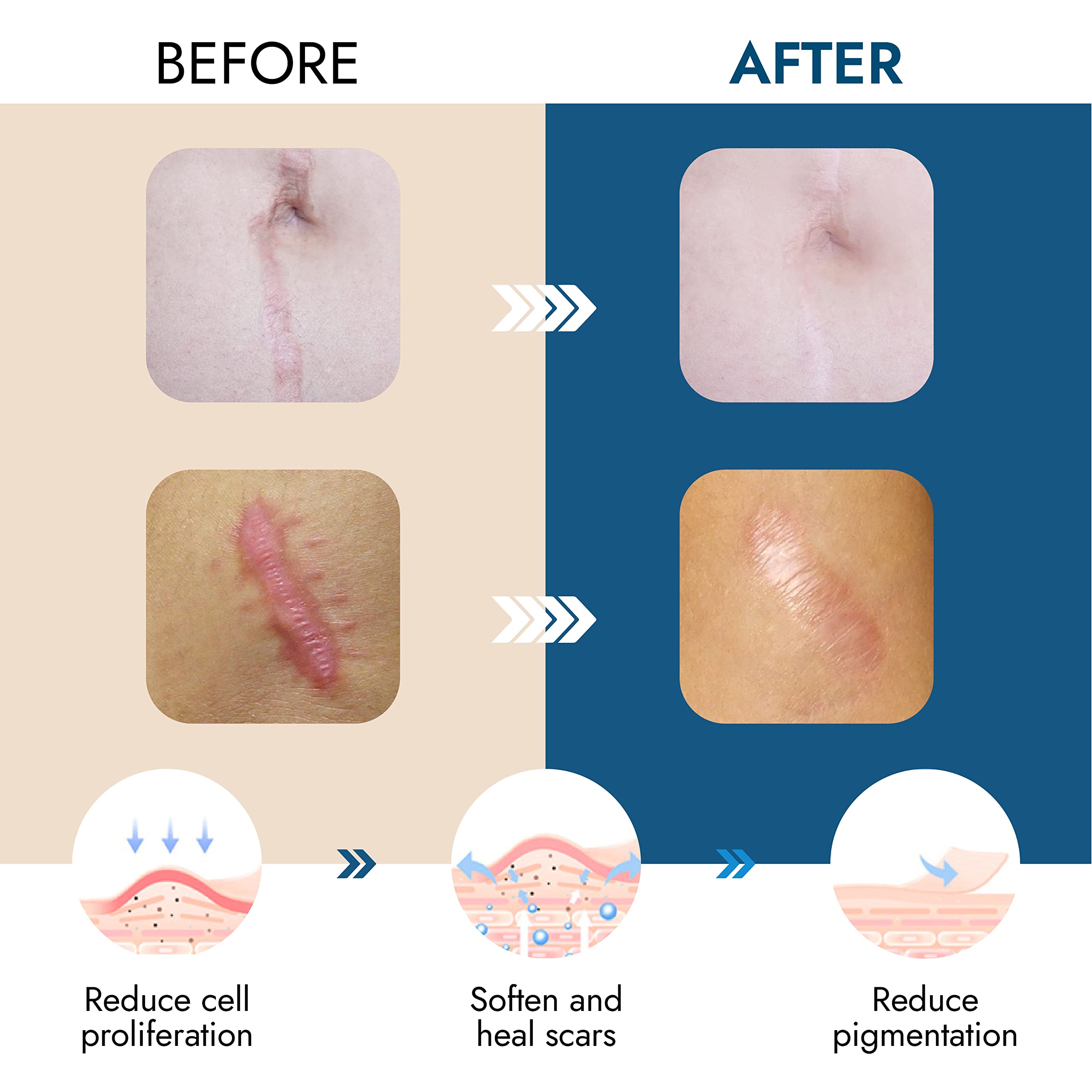 Mua Scarbandit Silicone Scar Sheets - Scar Patches Treatment for Keloid ...