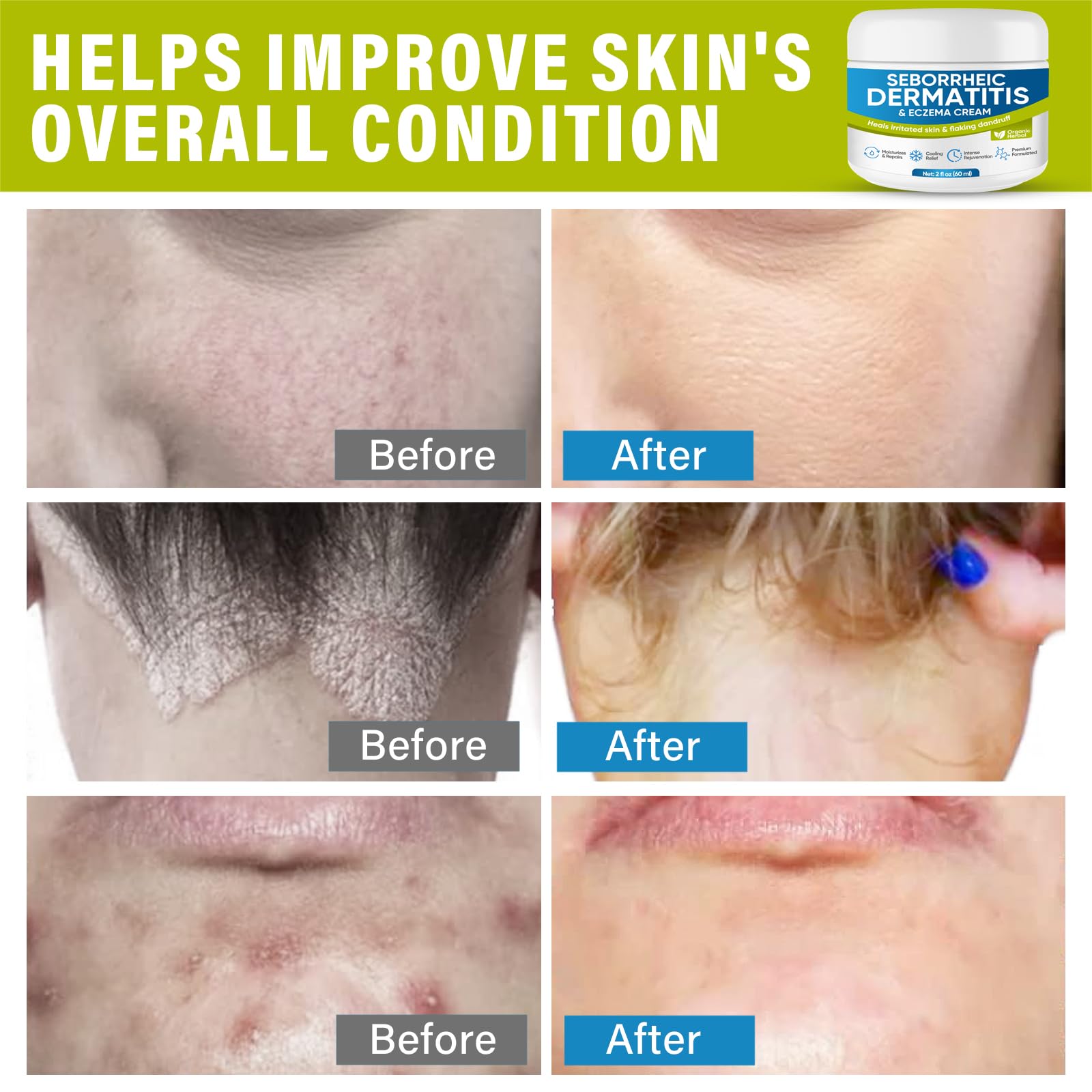 Seborrheic Dermatitis Cream, Fast Acting Seborrheic Dermatitis Scalp ...